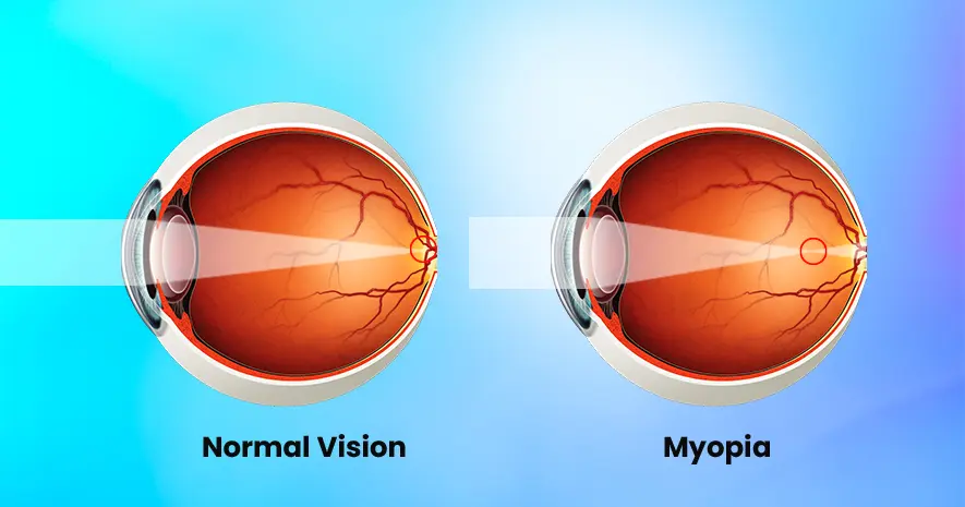 Is Myopia Stealing Your Sight? | Treatment at EyeMantra Optical